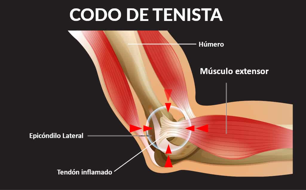 Dolor en el codo: ¿Qué es la epicondilitis y cómo curarla? - Fisioem ...